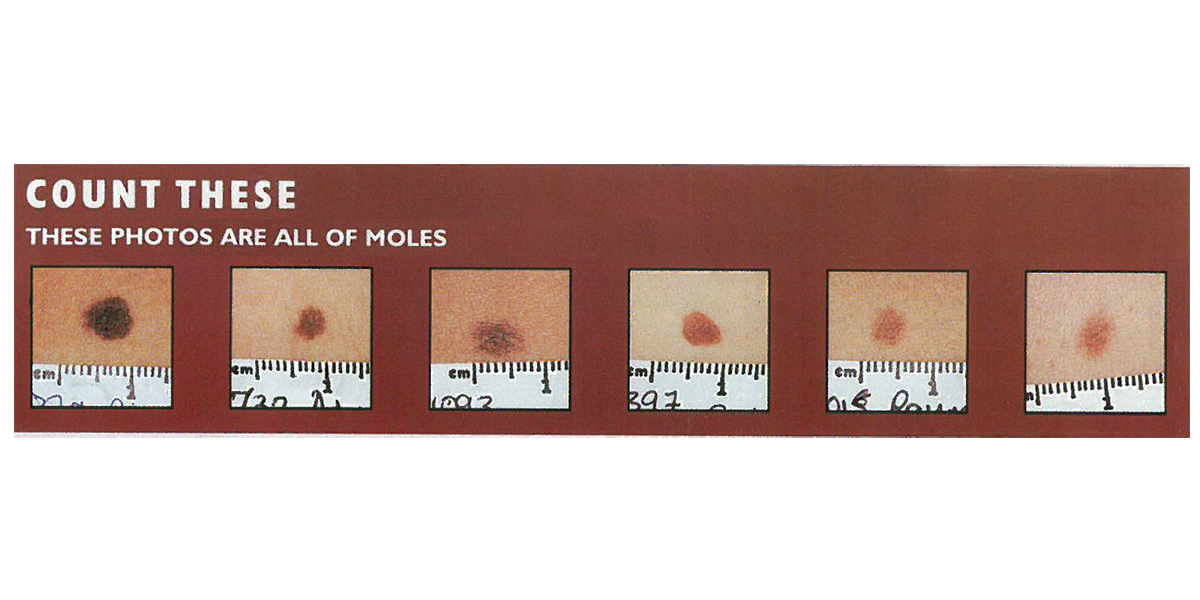 Mole Counting Pilot For UK Biobank School Of Medicine University Of Mole Counting Pilot For UK Biobank School Of Medicine University Of